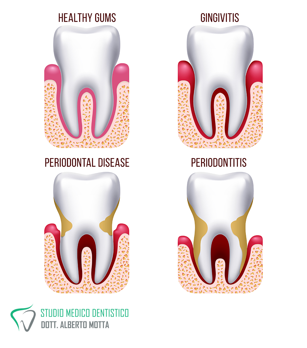 Sondaggio Parodontale · Dottor Motta